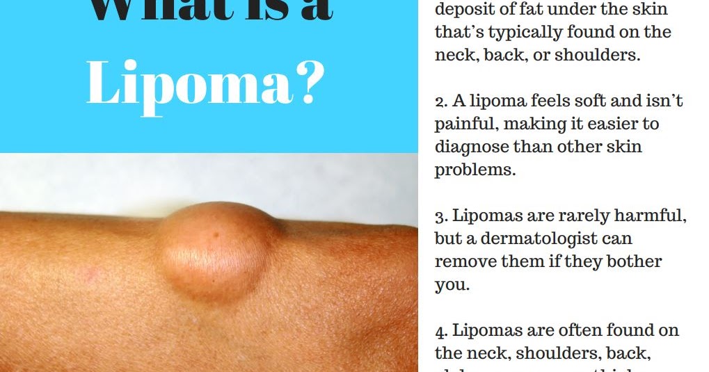 FindaTopDoc Blog: What is a Lipoma: Symptoms