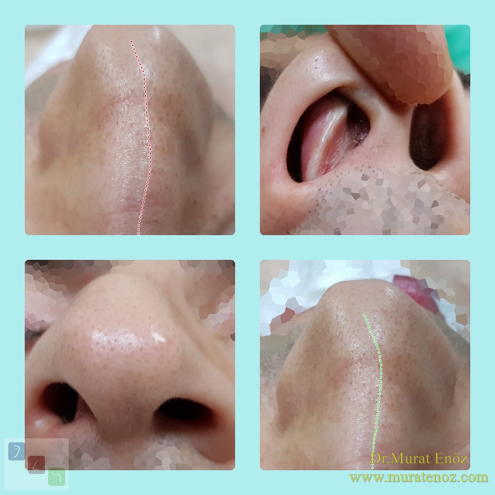 It May Be Necessary To Keep The External Splint On The Nose Longer Than ...