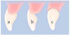 Pontik GTJ | SERBA SERBI DENTISTRY