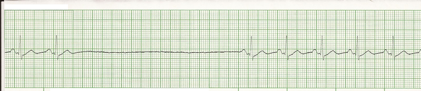 EKG Rhythm Strip Quiz 51: Sinus Rhythms