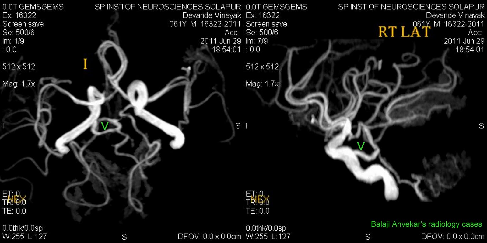 Dr Balaji Anvekar's Neuroradiology Cases: Persistent Trigeminal Artery
