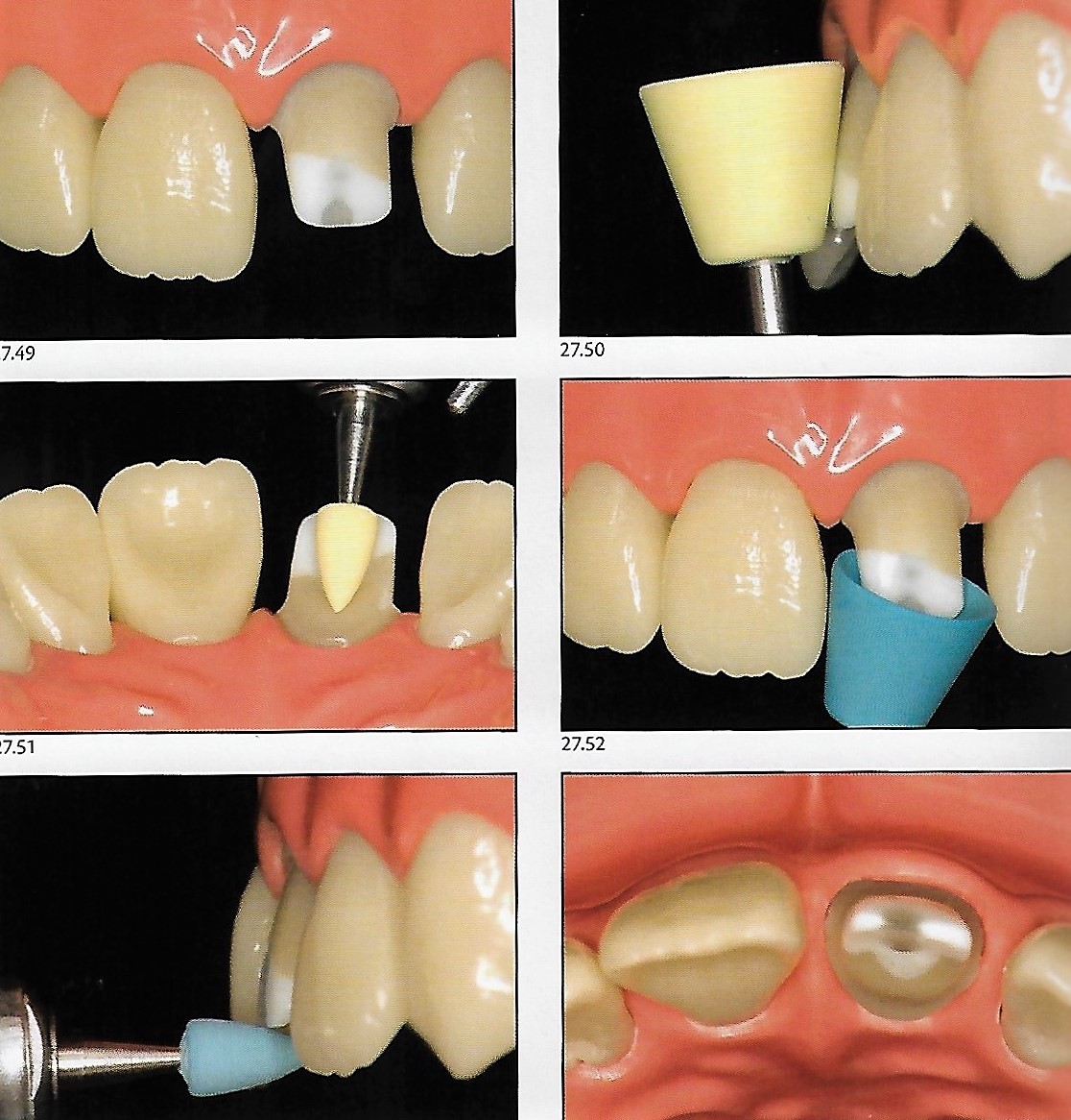 Anterior Crown Preparation | Dental Esthetics