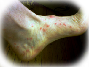 How to Treat Flea Bites on Humans ~ Kill Fleas