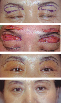 Eyelid Surgery by Prof Dr CN CHUA 蔡鐘能: Doctor, could you lift my ...