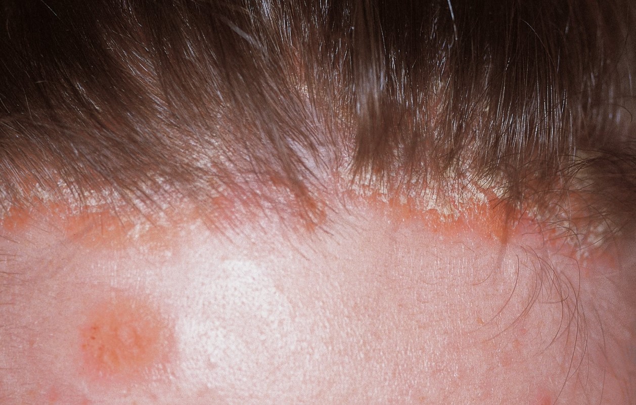 Seboreik Dermatit Nedir? Nedenleri, Belirtileri, Tanısı ve Tedavisi