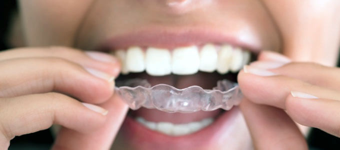 Rekomendasi Retainer Gigi di Jakarta - Retainer Gigi Jakarta