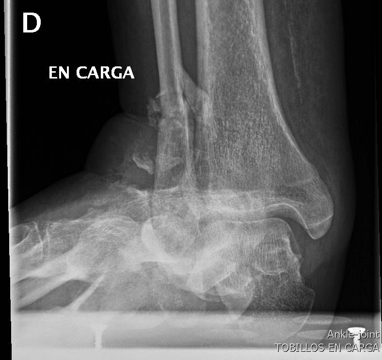 Salud Osteoarticular: CORRECCIÓN DE PIE PLANO-VALGO REUMATICO