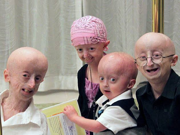 ramas de la biologia: progeria, implicaciones sociales y medicas