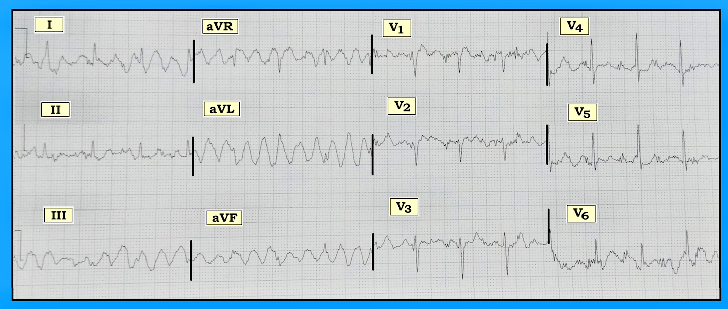 ECG Interpretation: ECG Blog #148 (Ventricular Fibrillation - VFib ...
