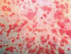 Medical Treatment Pictures-for Better Understanding: Toxic Shock Syndrome