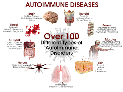 West Cary Family Physicians: Graves Autoimmune Disease- Symptoms ...