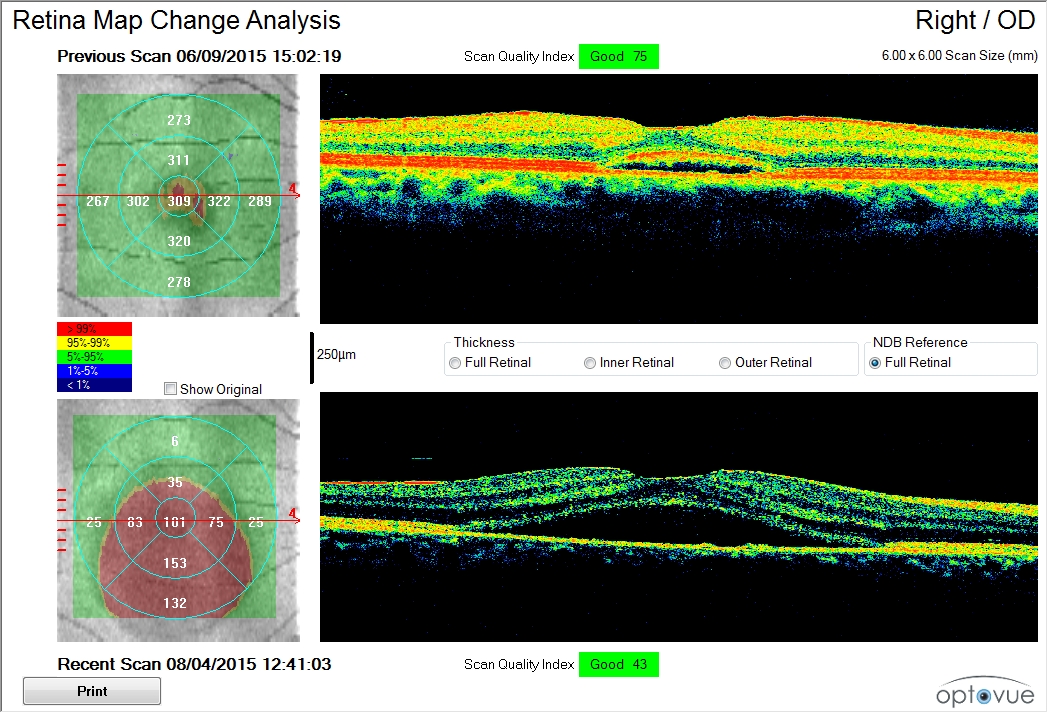 Sonoran Desert Eye Center: CENTRAL SEROUS RETINOPATHY