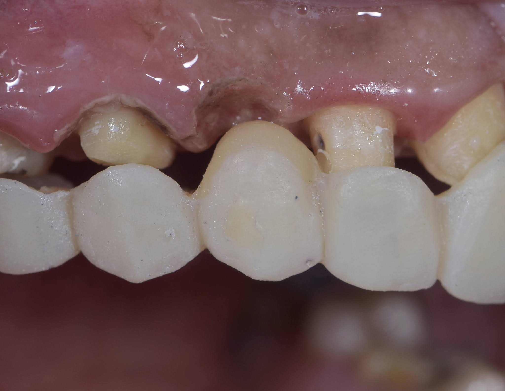 Ovate pontic for the correct emergence profile.. A clinical case ...