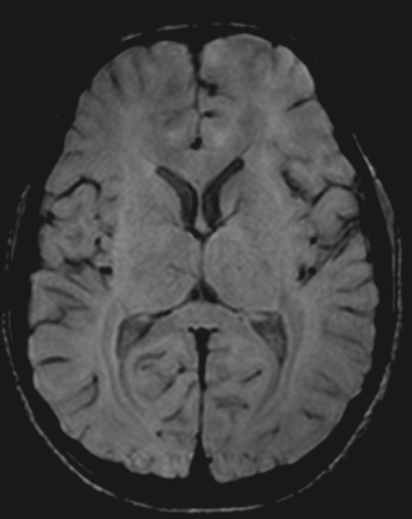 Opercular Syndrome-MRI - Sumer's Radiology Blog