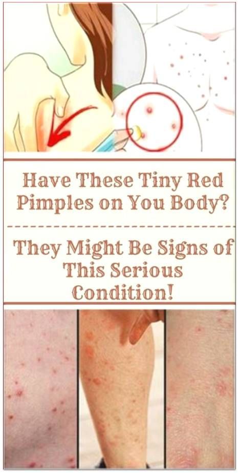 Have These Tiny Red Pimples on You Body? They Might Be Signs of This ...