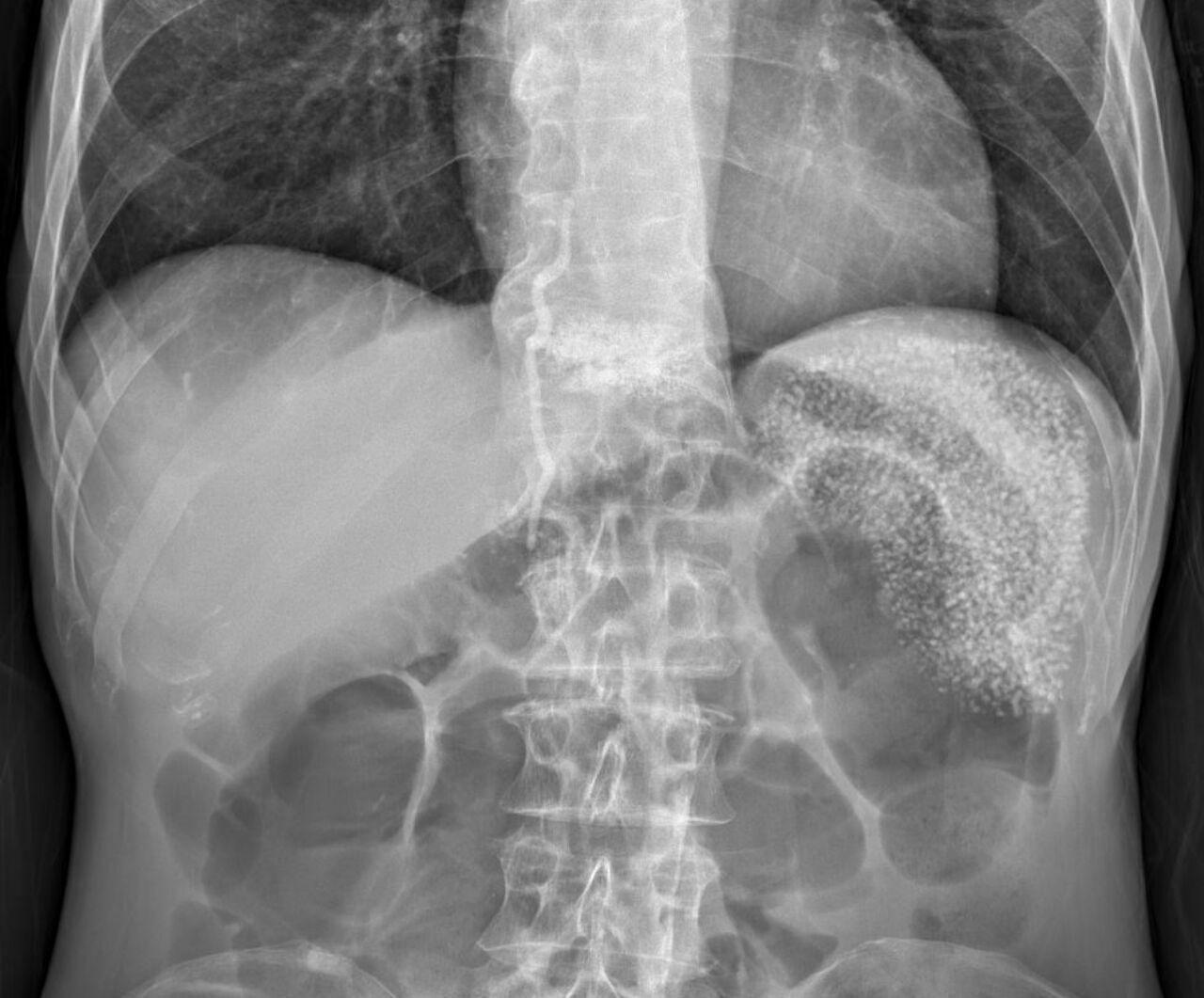 Splenic calcification - SAMPLE