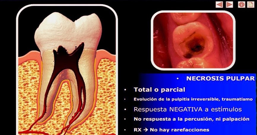 PDF: Necrosis Pulpar, Síntomas y Tratamiento - Ovi Dental
