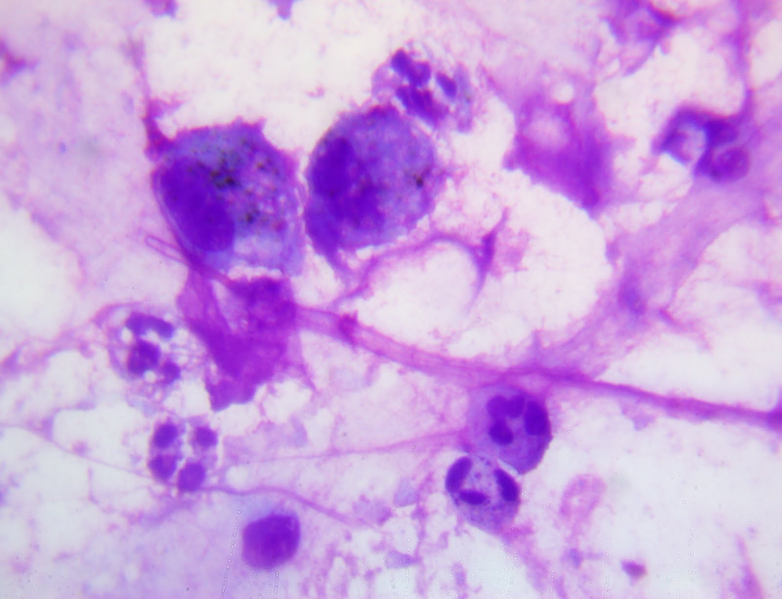 Citograma : Rinitis purulenta