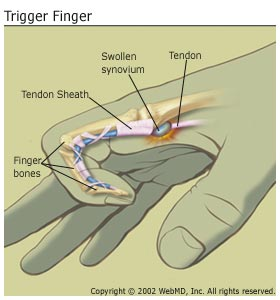 Diabetic Cheiroarthropathy