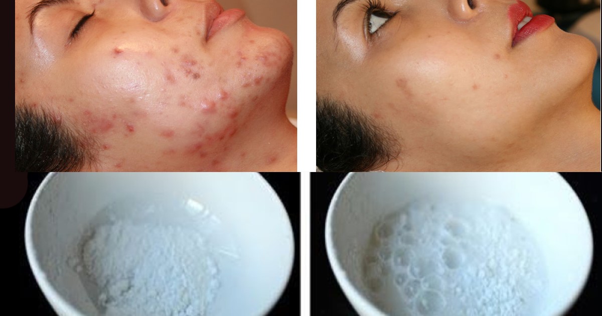 Acne, Pimples and Blackheads : Remove Blackheads With This one ...