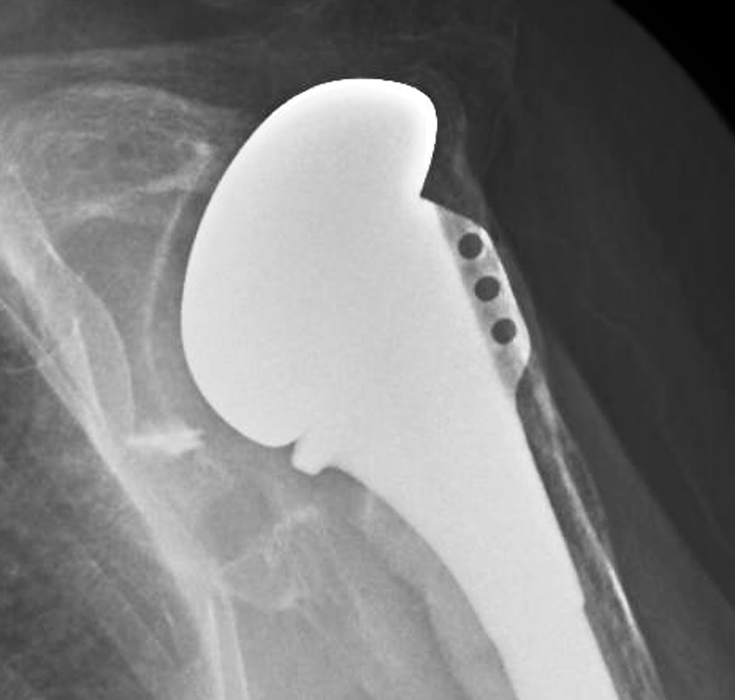 UW Shoulder and Elbow Academy: Shoulder joint replacement - selecting ...