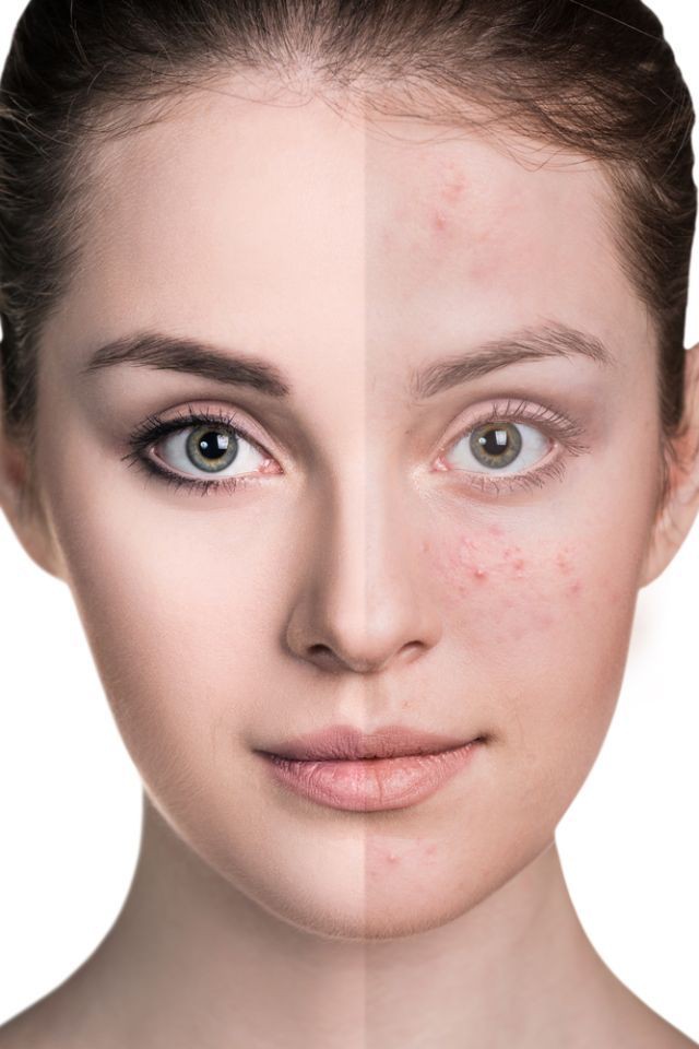 Beauty.id: PERBEDAAN BREAKOUT DAN PURGING