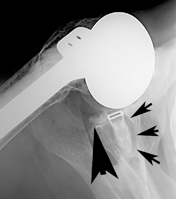 Shoulder Arthritis / Rotator Cuff Tears / Shoulder Pain : CT for ...