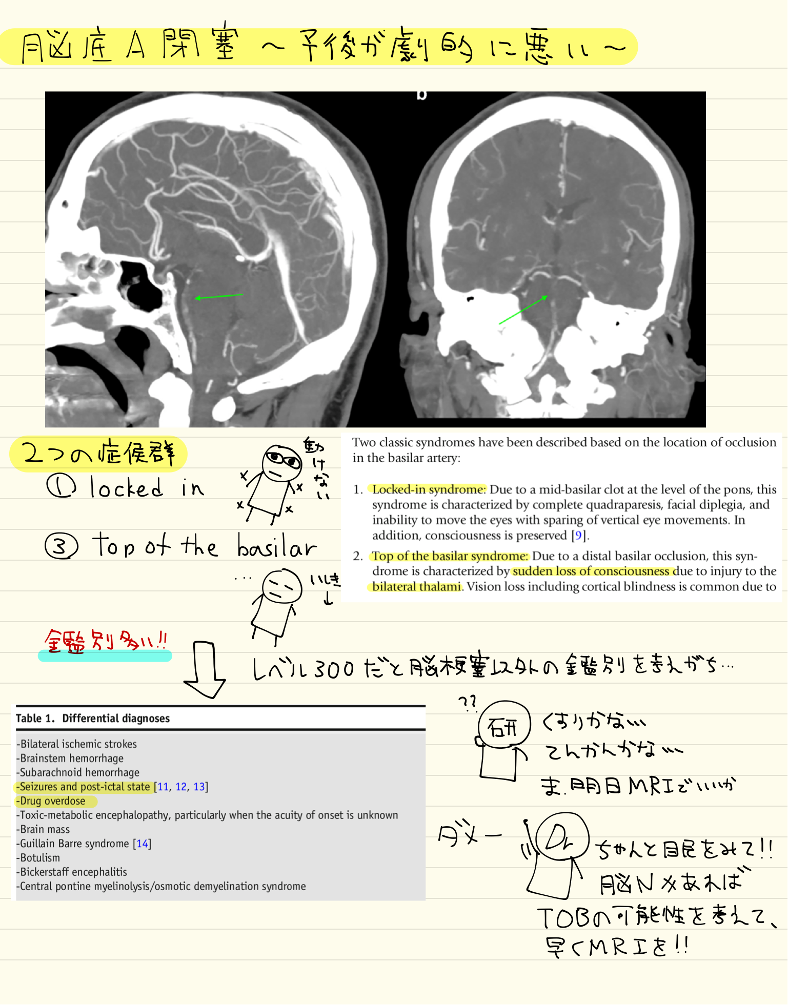 Dr Note〜いつも心に〜: Top of the basilar syndrome 〜一見、脳梗塞に見えない時も〜