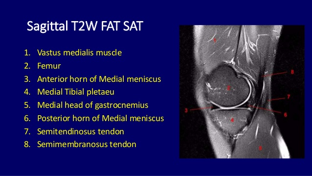T2 Mri Of The Knee