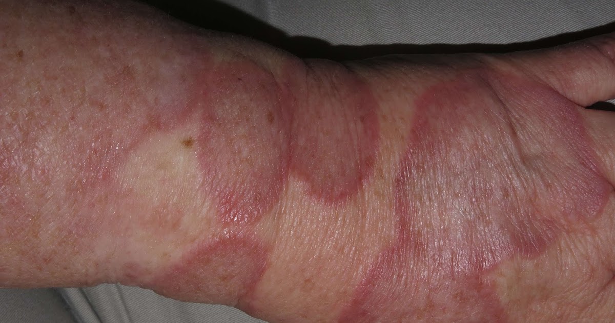 Dermapixel: Unas ronchas curiosas