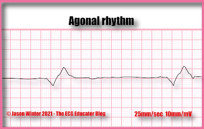 ECG Educator Blog : Agonal Rhythm