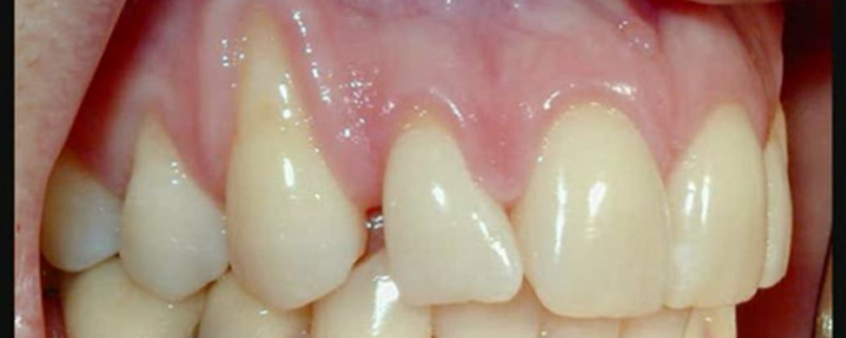 Porphyromonas Gingivalis