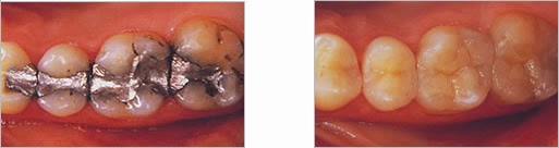 Dr. Marty Frankel : Neuromuscular Dentistry: Tooth Decay ... Otherwise ...