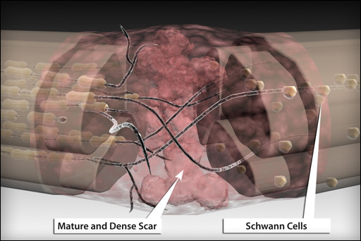 Spectator-Ion: Nerve Regeneration After Injury