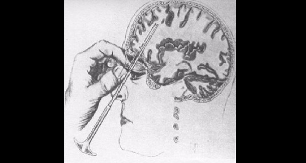 10 Prosedur Bedah yang paling Aneh di Dunia