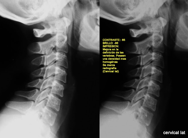 RadioLuz: Radiografía cervical lateral normal