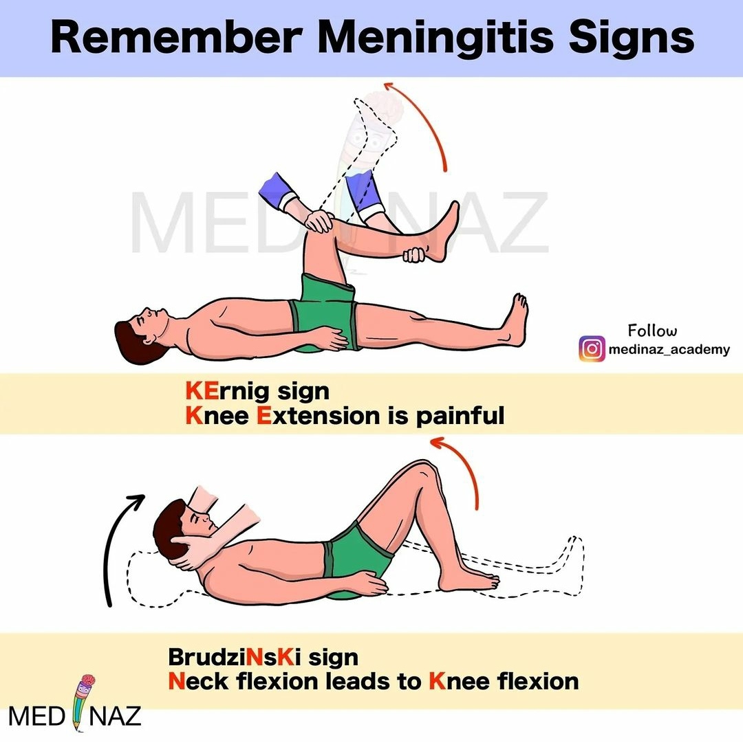 Kernig Sign and Brudzinski Sign - Mnemonic