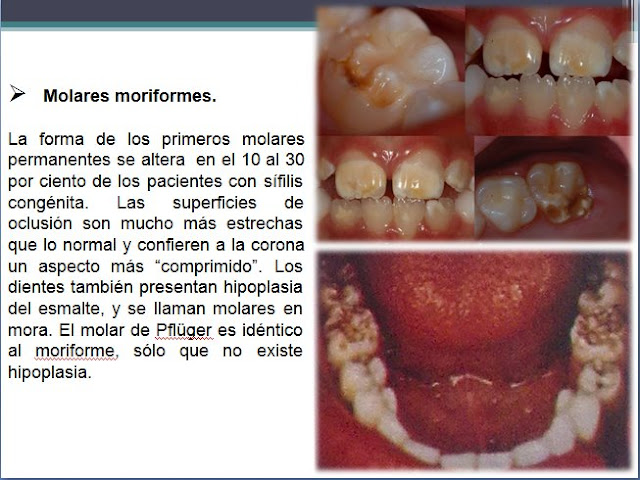 DENTAL 1001 UNAM: Macro y Microdoncia, y otras Anomalías Dentales ...
