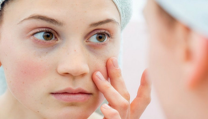 8 Early Warning Signs And Symptoms Of Lupus In Women Analajmal 8-early-warning-signs-and-symptoms-of-lupus-in-women-analajmal