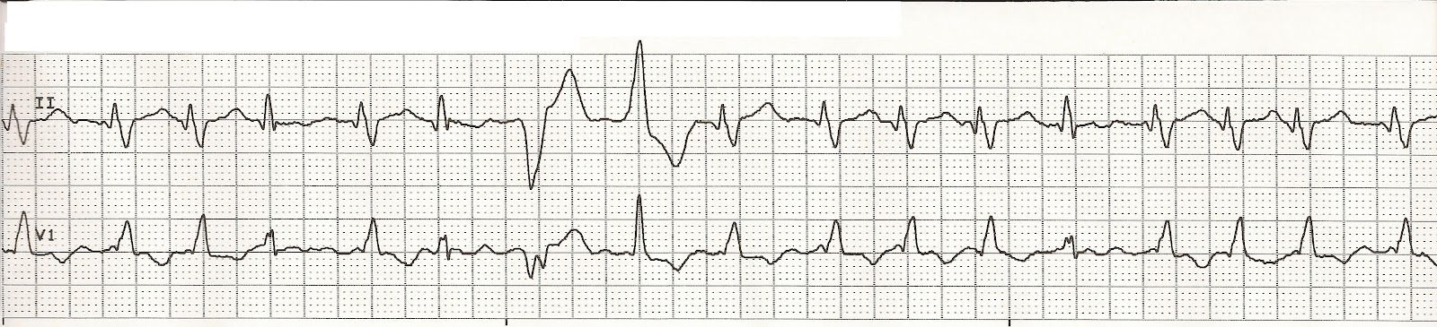 EKG Rhythm Strips 58