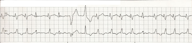 EKG Rhythm Strips 58