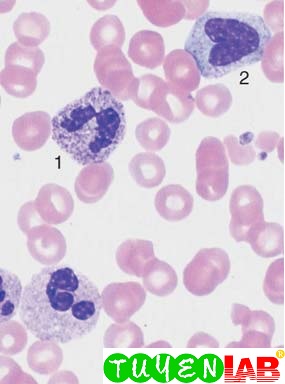 [Haematology] Abnormalities of the White Cell Series | Free Medical Atlas