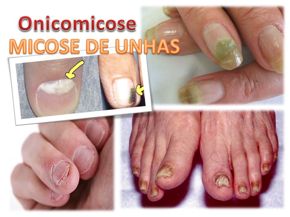 Saúde em Foco: MICOSE DE UNHA (Onicomicose)