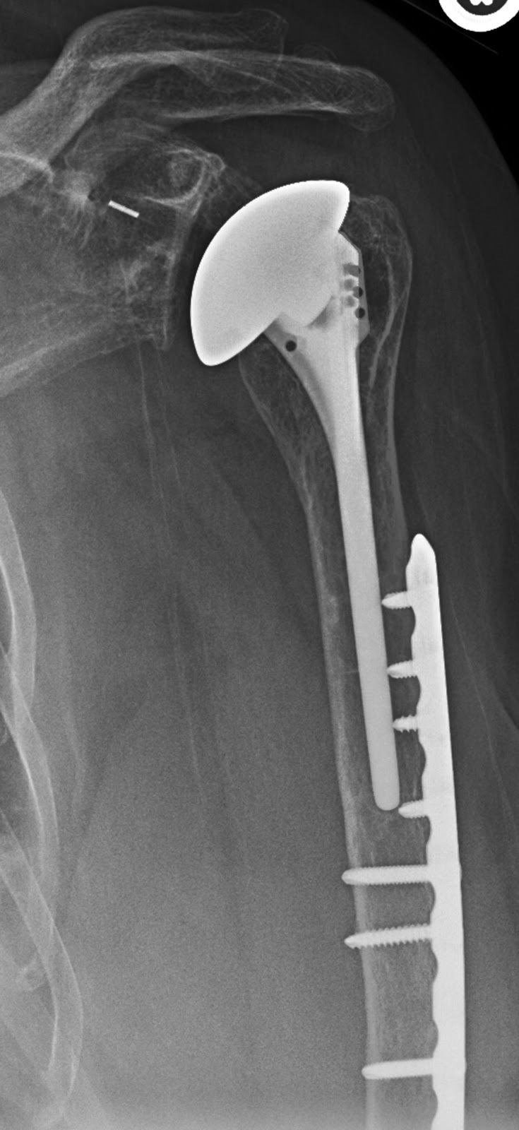 UW Shoulder and Elbow Academy: Shoulder joint replacement - humeral ...