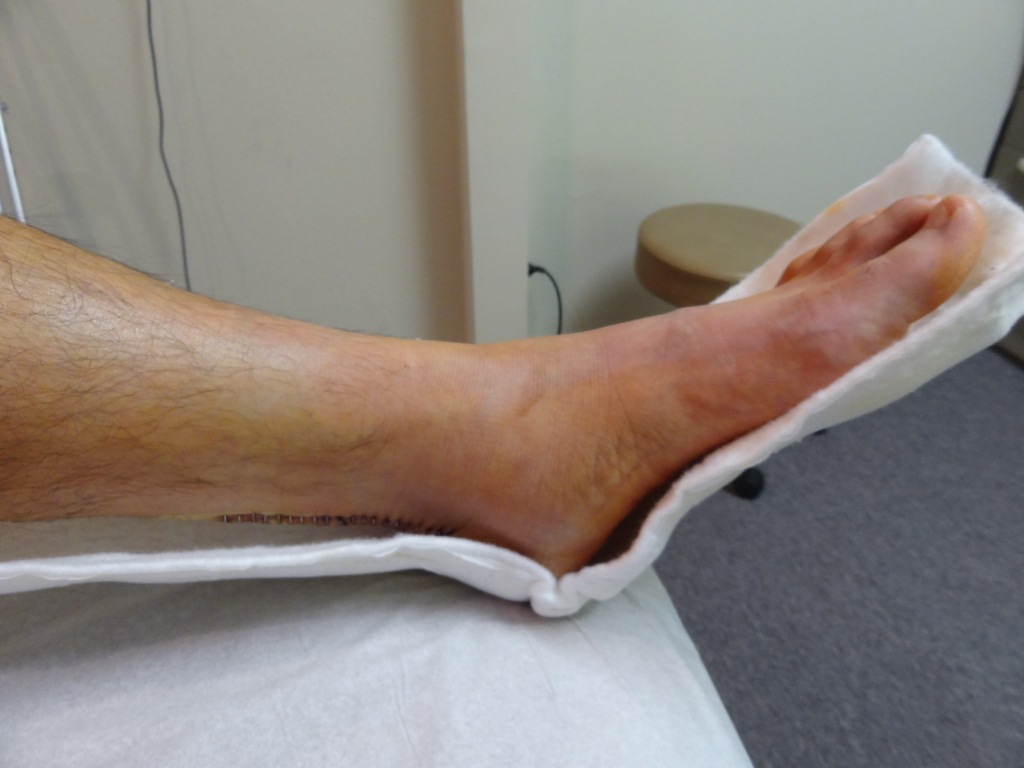 Run Lily Run: Ruptured Achilles Tendon - Day 16 - Post Op Day 4