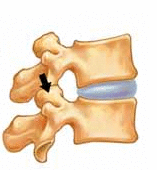 FACET JOINT PAIN OR SYNDROME EXERCISES, CAUSES, SYMPTOMS AND TREATMENT