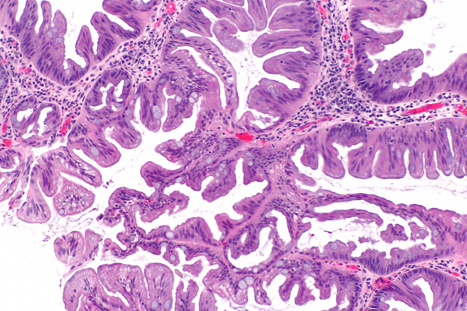 Review of serrated lesions by JCP