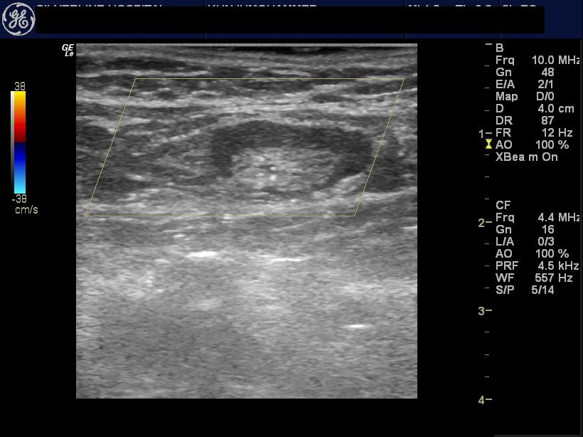 Ultrasound imaging: Normal and enlarged lymph nodes: