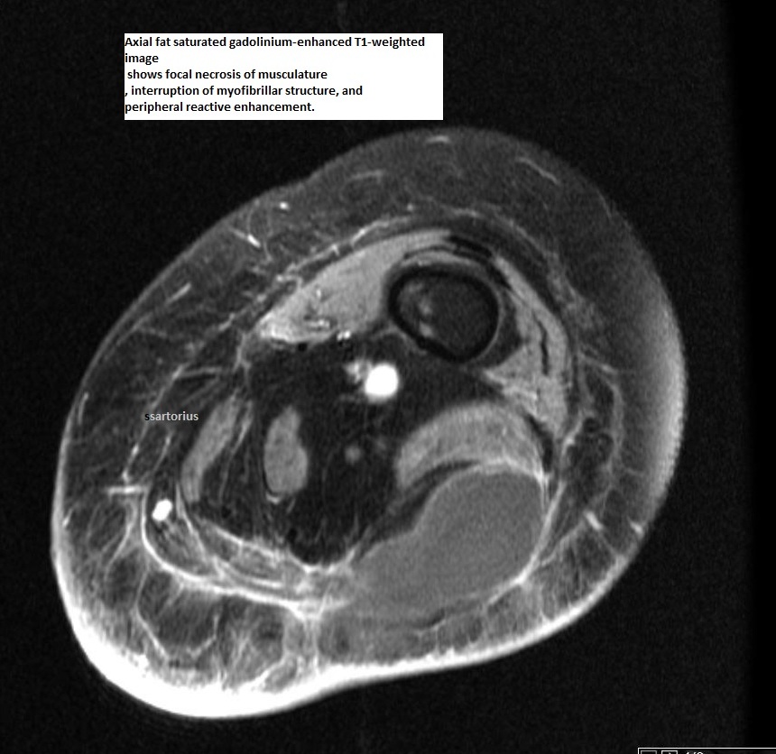 Diabetic myonecrosis-MRI - Sumer's Radiology Blog
