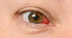 How to treat a poked eye